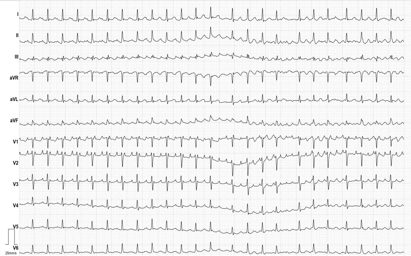 Atrial Flutter Degenerates Into Atrial Fibrillation Ecg Guru Instructor Resources